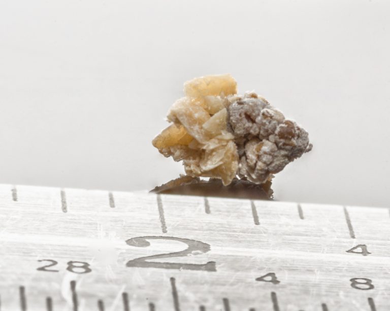 Kidney stones- causes,symptoms and treatment- Qoctor your online doctor