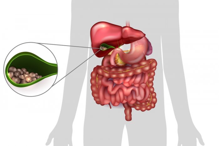 What are gallstones and why do they happen? Qoctor-your online doctor