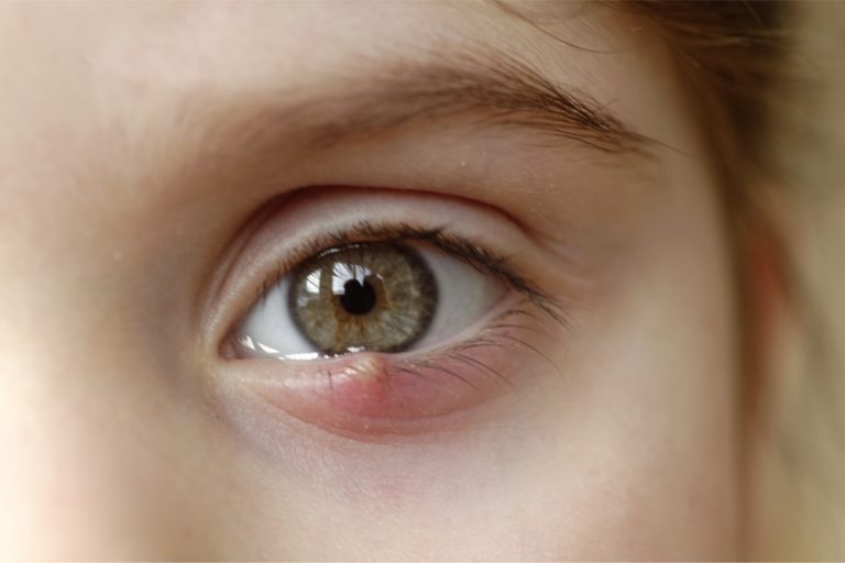 What is a stye and how do you treat it? - Qoctor your quick online doctor