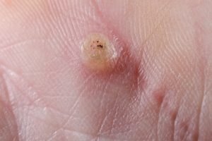How to treat warts- what actually works? - Qoctor your quick online doctor